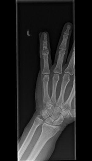 Encondroma | Imagen Diagnóstica