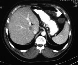 A Massive Hepatic Infarction After Radiofrequency Ablation | Cirugía ...