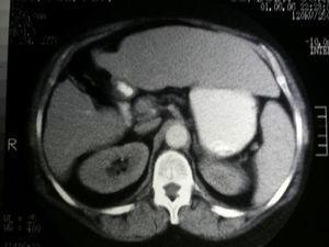 Right Liver Atrophy and Cirrhosis Due to an Isolate Portal Vein Injury ...
