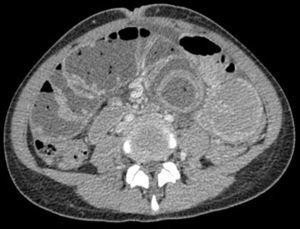 Abdominal Cocoon Syndrome: A Diagnostic and Therapeutic Challenge. Case ...