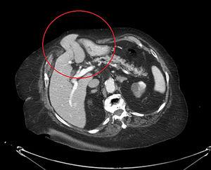Abdominal eventration with massive visceral content | Cirugía Española ...