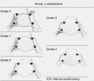 Endoscopic endonasal surgery for pituitary tumors. Results in a series ...