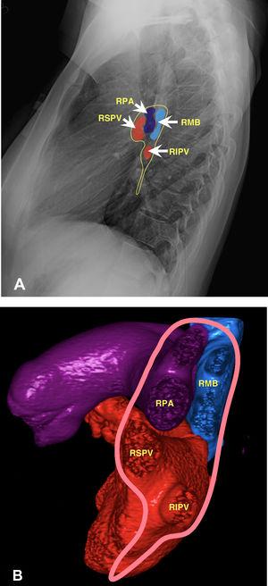 The hilum of the lung: Two classical radiological signs to decipher it ...