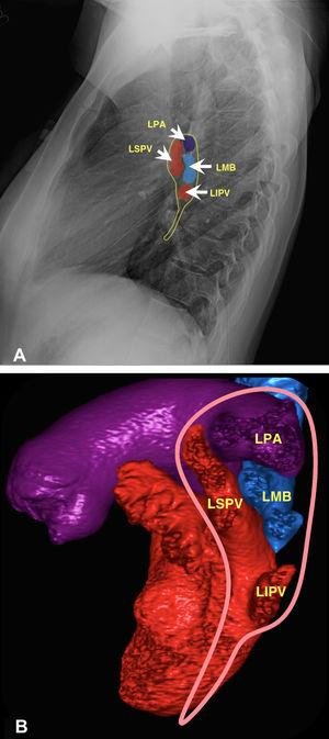 The hilum of the lung: Two classical radiological signs to decipher it ...