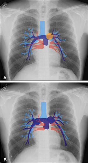The hilum of the lung: Two classical radiological signs to decipher it ...