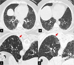 Idiopathic pulmonary fibrosis | Radiología (English Edition)