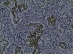 Lung adenocarcinoma: Sustained subtyping with immunohistochemistry and ...