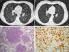 A rare cause of miliary pattern and respiratory failure – Benign ...