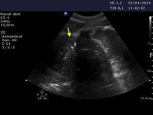 Early diagnosis of traumatic diaphragmatic rupture | Medicina Intensiva