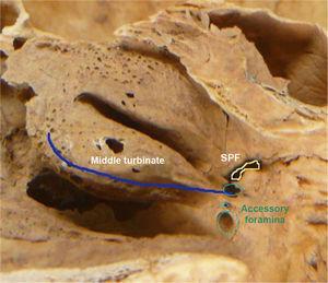 Sphenopalatinum Foramen: An Anatomical Study | Acta ...