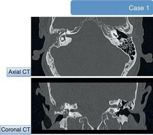 Management of Cerebrospinal Fluid Otorrhea | Acta Otorrinolaringológica ...