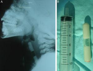 A Novel Laryngeal Stent in the Treatment of Subglottic Stenosis in ...