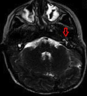 Lipoma of the Middle Ear: An Unusual Presentation in a 6 Year Old Child ...