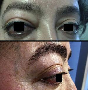 IgG4-related orbital pseudotumor | Reumatología Clínica