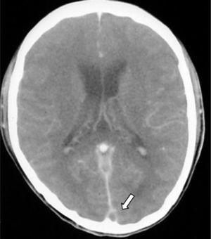 Cerebral venous thrombosis: A diagnostic and treatment update ...