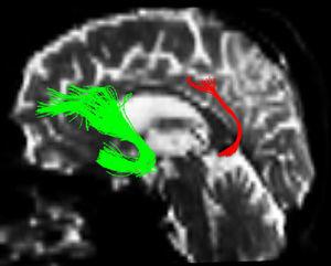 Tractography of the uncinate fasciculus and the posterior cingulate ...