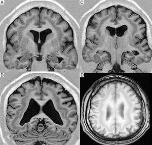 Double cortex syndrome in a male patient without lissencephaly ...