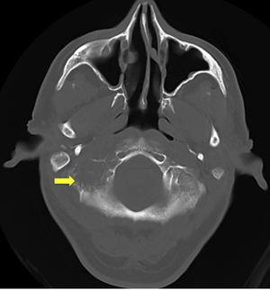 Occipital condyle syndrome as the first manifestation of a rectal ...