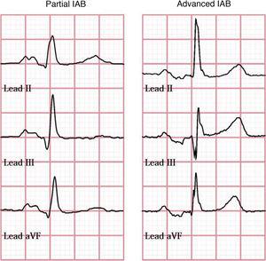 Embolic stroke of undetermined source: beyond atrial fibrillation ...