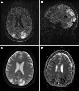 Posterior reversible encephalopathy associated with pembrolizumab ...