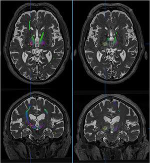 The role of tractography in the localisation of the Vim nucleus of the ...