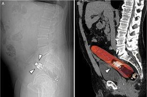 Rectal foreign body | Revista de Gastroenterología de México