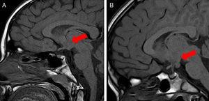 Forms of clinical presentation of hypothalamic hamartoma | Anales de ...