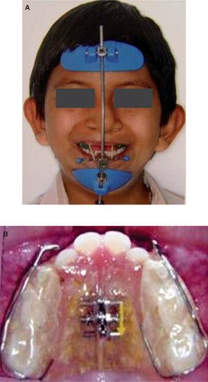 Anteroposterior and vertical maxillary changes with facial mask use in ...