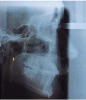 Technical description subapical osteotomy in the treatment of ...