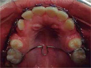 Micro-osteoperforations for accelerating tooth movement during canine ...