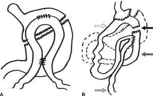 The origin of the «simplified gastric bypass» | Cirugía y Cirujanos ...