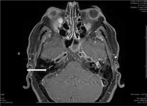 Cogan's syndrome: A case report with partial response to tocilizumab ...