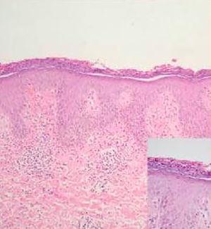 Unusual presentation of psoriasis ostracea and psoriatic arthritis ...