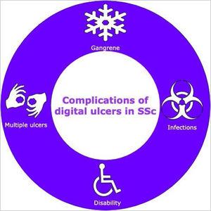 Digital ulcers in systemic sclerosis | Revista Colombiana de ...
