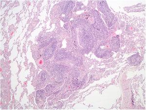 Follicular bronchiolitis, a frequently misdiagnosed condition | Pulmonology