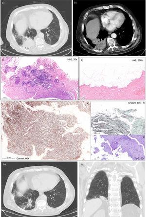 IMAGES: Nocardia pneumonia – A surprising and rare pulmonary infection ...