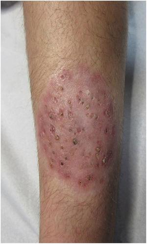 Skin infection due to Trichophyton tonsurans | Medicina Clínica Práctica