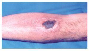 Loxoscelismo cutáneo necrótico. Informe de un caso | Revista Alergia México