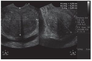 Ecografía y biopsia prostáticas en la detección del carcinoma ...