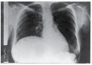 Tratamiento de quistes hepáticos no parasitarios gigantes con ...