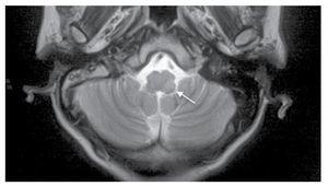 Síndrome de Wallenberg: presentación de un caso clínico y revisión de ...