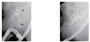 Diagnóstico de colangitis esclerosante primaria con ultrasonido ...