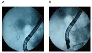 Drenaje endoscópico de la vesícula biliar en colecistitis aguda ...