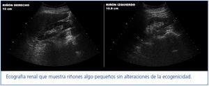 Fracaso renal agudo en el contexto de un síndrome de Takotsubo | Nefrología