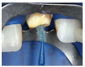 Cementado de pernos intrarradiculares reforzados con fibra | Quintessence