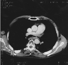 Compresión extrínseca de la arteria pulmonar por un carcinoma no ...