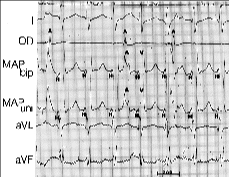 Taquicardia ectópica congénita de la unión auriculoventricular ...
