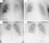 Combined intrapleural therapy in infectious pleural effusion | Pulmonology