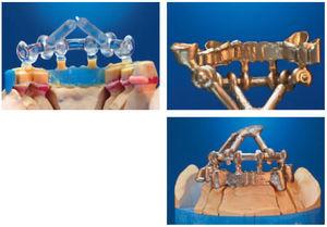 Técnica de colado dental. Problemas de la implementación de la técnica ...