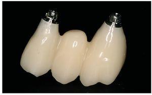 La confección racional de prótesis provisionales de PMMA sobre ...